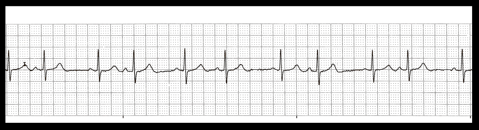 Float Nurse: Practice EKG Strips 312