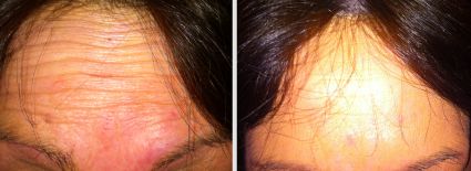 Face Exercises To Eliminate And Reduce Forehead Wrinkles