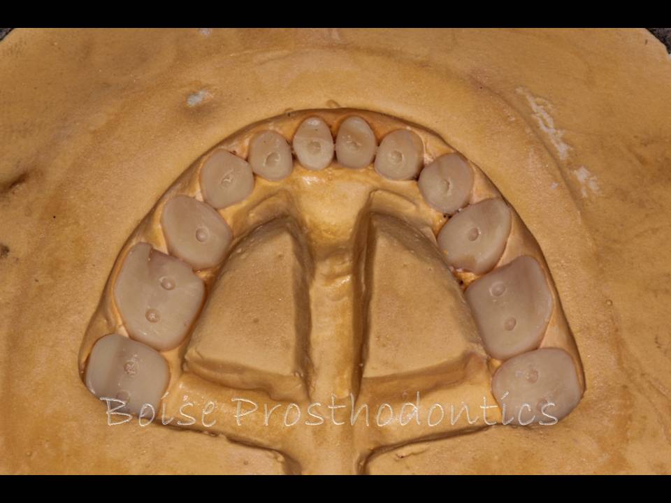 Boise Idaho Prosthodontics: Picture Sequence of Maxillary Complete ...