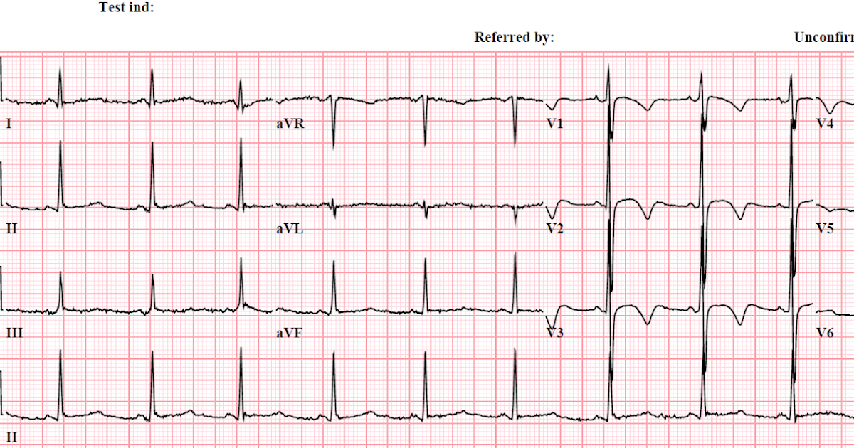 Dr. Smith's ECG Blog: T-wave inversion in a young woman with ...