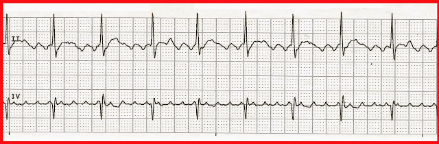 Practice EKG Rhythm Strips 226