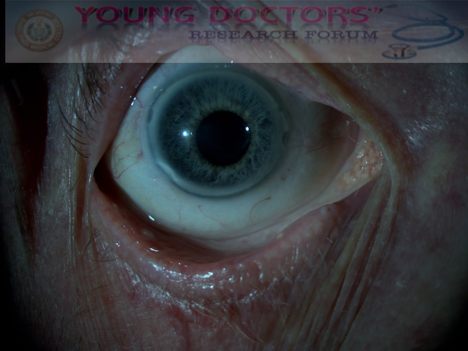 Arcus Senilis as related to Corneal injury - Pictures