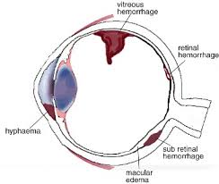 Eye Structures Involved In Contusion Ocular Injury : Sight Medical Blog