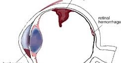 Eye Structures Involved In Contusion Ocular Injury : Sight Medical Blog