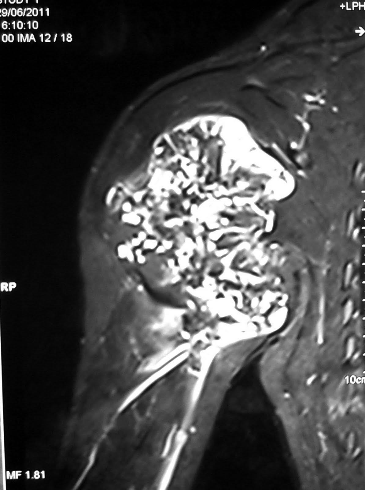 Radiodiagnosis - Imaging is Amazing-Interesting cases: Secondary ...