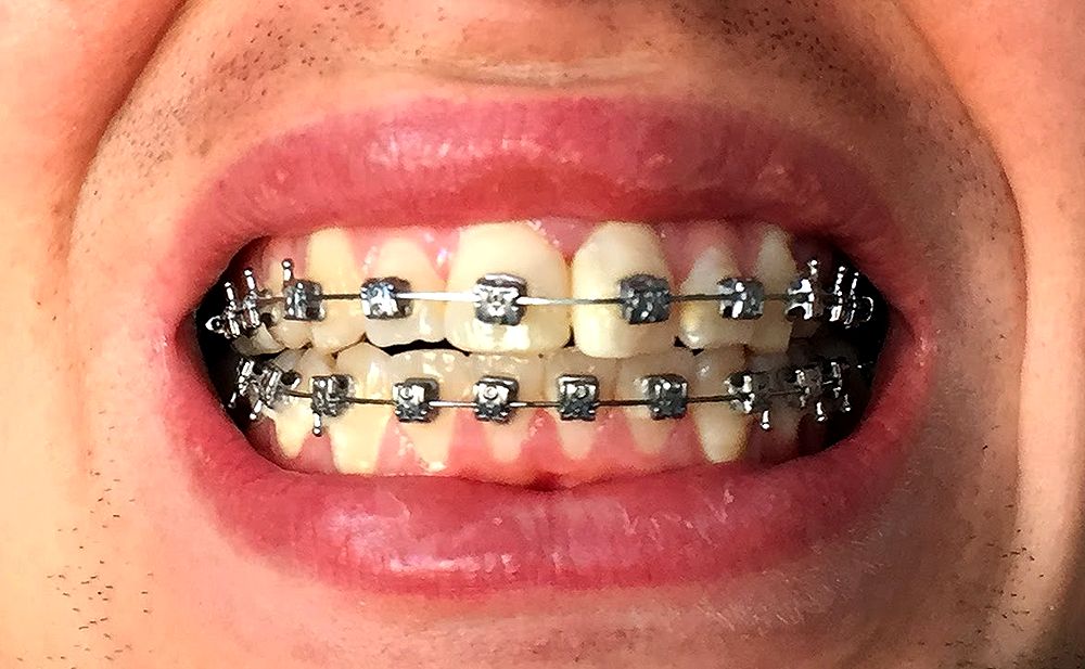 ORTODONCIA : Todo lo que tienes que saber antes de ponerte brackets
