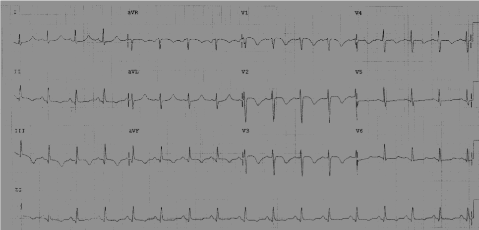 Two EKG patterns of pulmonary embolism which mimic MI