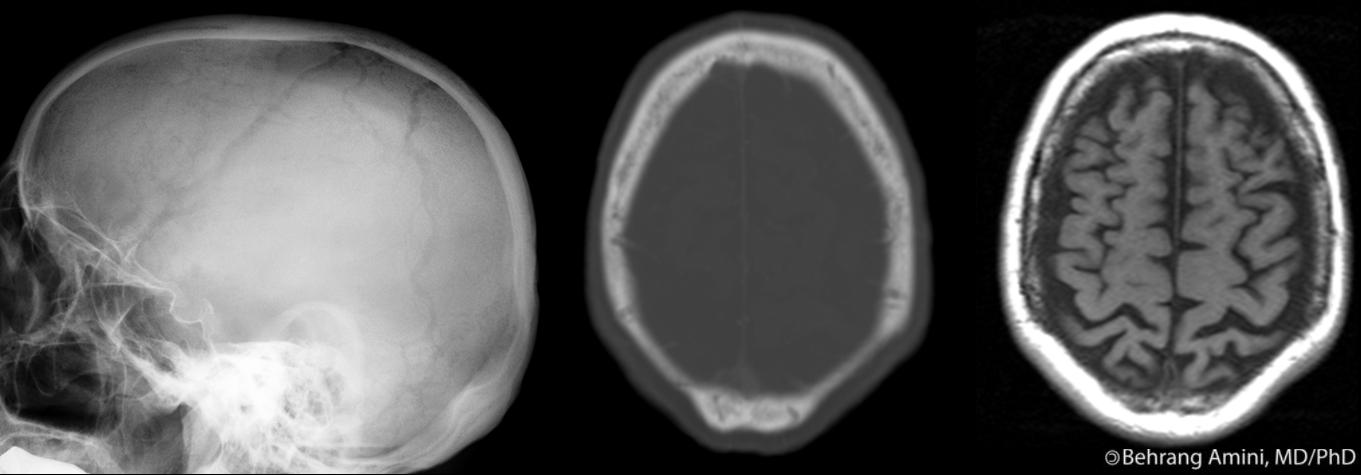 Roentgen Ray Reader: Parietal Thinning