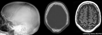 Roentgen Ray Reader: Parietal Thinning
