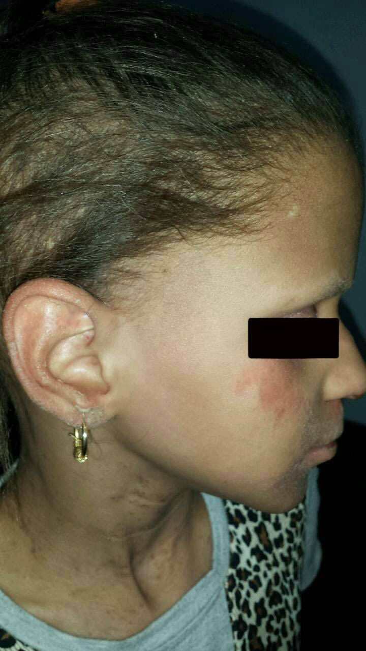 VIRTUAL GRAND ROUNDS IN DERMATOLOGY 2.0: Tay Syndrome (Trichothiodystrophy)