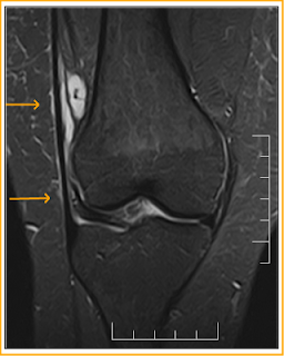 Iliotibial Band Syndrome-MRI - Sumer's Radiology Blog