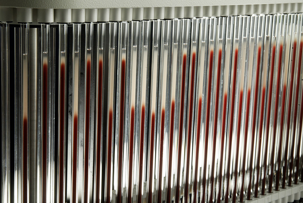 Erythrocyte Sedimentation Rate Esr Westergren Technique Medical Laboratory Technology