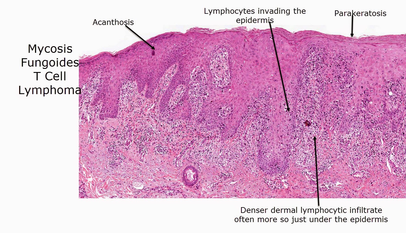 Mycosis Fungoides Histology