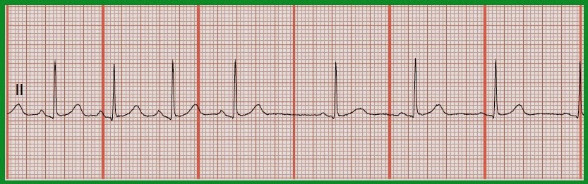 EKG Rhythm Strip Quiz 182