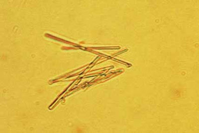 [Haematology] Microscopic Examination of Urinary Sediment - Crystals ...
