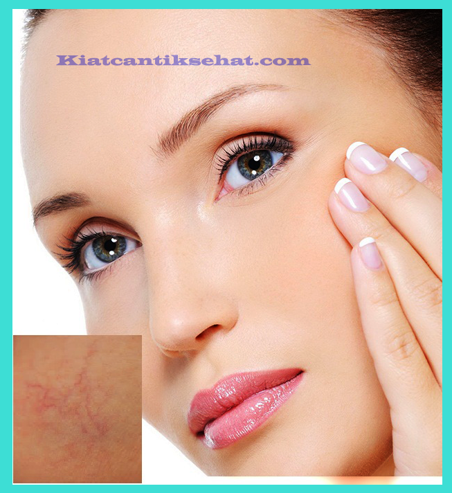 Cara Alami Menghilangkan Urat Urat Halus Di Wajah ~ Info seputar cantik ...