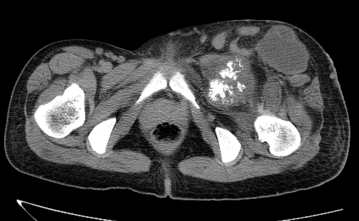 Pelvic Osteosarcoma-CT - Sumer's Radiology Blog