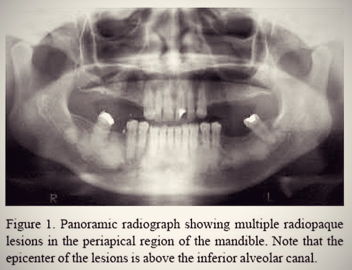 PDF: Florid cemento-osseous dysplasia: a case report - Ovi Dental