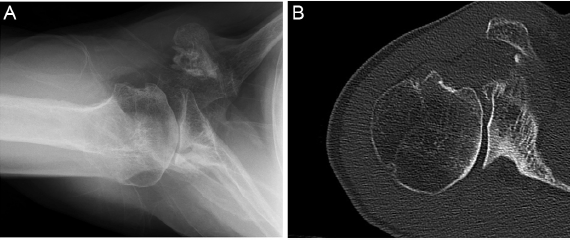 UW Shoulder and Elbow Academy: Is a CT scan needed before a shoulder ...