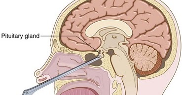 What is Transsphenoidal hypophysectomy - Definition, Symptoms, Causes ...