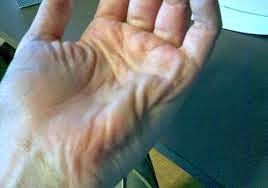Diabetes Hand Pain Swollen