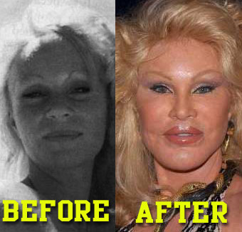 LIP AUGMENTATION: EDUCATION 101