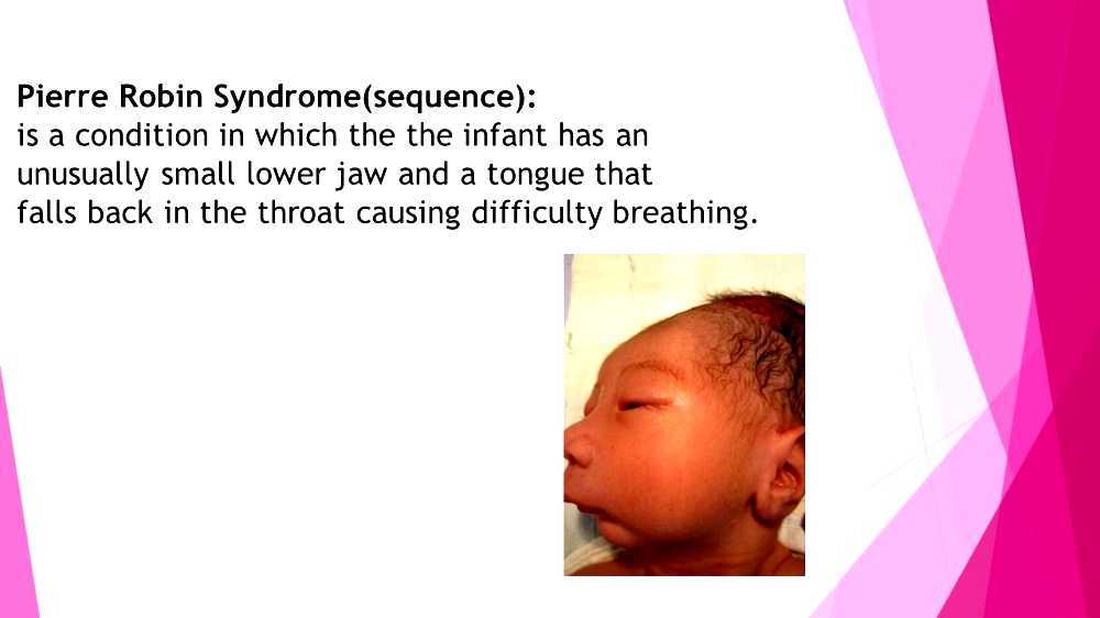 Pierre Robin syndrome