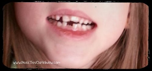 The Wiggly & Jiggly of Loose Teeth