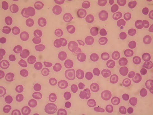 FICHERO DE HEMATOLOGÍA: ANORMALIDADES ERITROCITARIAS. Anormalidades en ...