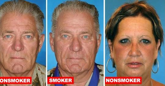 Photos Of Twins Show Drastic Difference Between Smokers And Non-Smokers