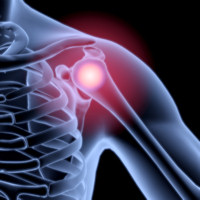Traumagency: POCUS For Shoulder Dislocation