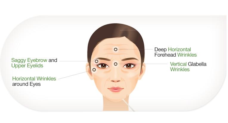 Eyelid Surgery Legend Dr. Kim Byung Gun: [BK Plastic Surgery Hospital ...