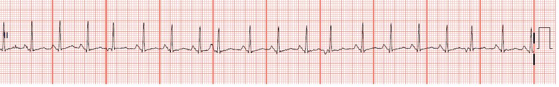 EKG Rhythm Strip Quiz 19