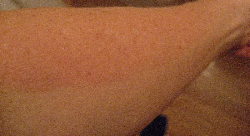 Chemical Peels for Acne and Anti Aging: 25% TCA Peel for Arms: Day 15