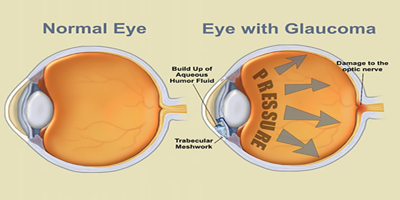Glaucoma Surgery Procedure - Trabeculectomy and Sclerectomy - Eye ...