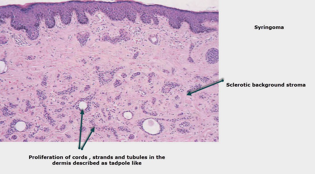 Dermpath Made Simple - Neoplastic: Syringoma