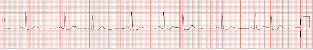 EKG Rhythm Strips 25: Ectopic beats