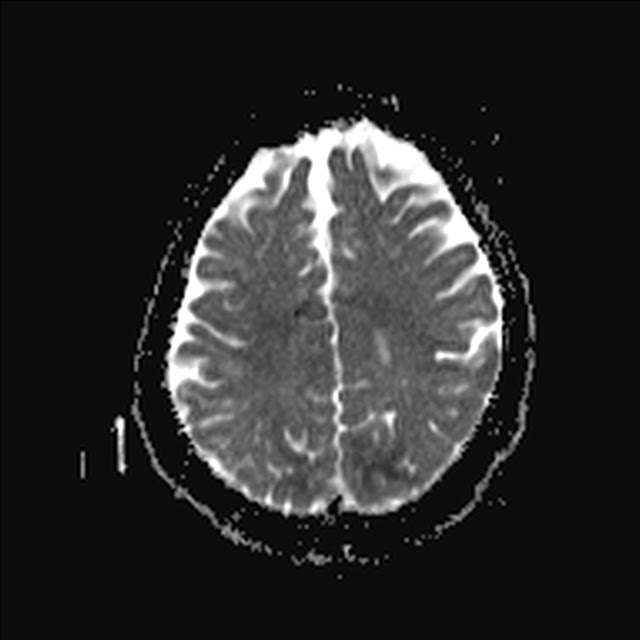 Ultimate Radiology : Hypoxic-Ischemic Brain Injury in a post cardiac ...