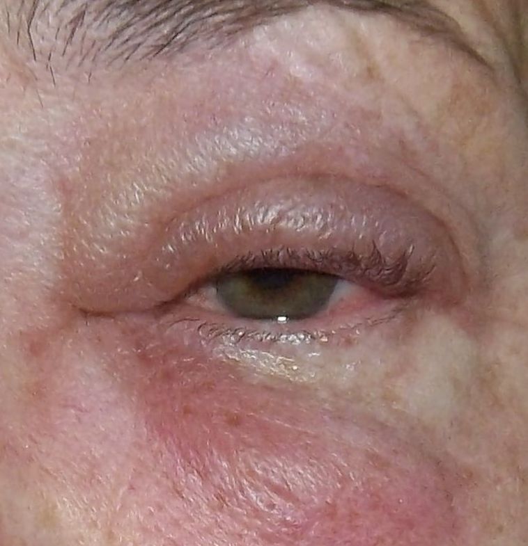 Eco Footprint ~ South Africa: Bug bites