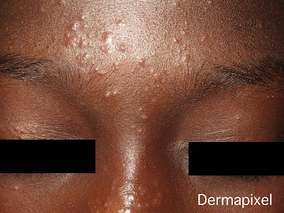 Dermapixel: Un acné muy extraño