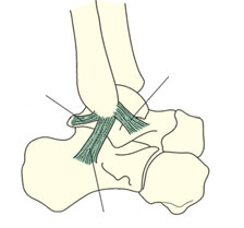 Bahan Belajar Mahasiswa Kesehatan: Cedera Engkel