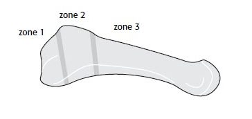 11:50: Fractura de Jones