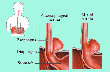 Hiatus Hernia Info: How you can Diagnose any Hiatus Hernia