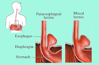 Hiatus Hernia Info: How you can Diagnose any Hiatus Hernia