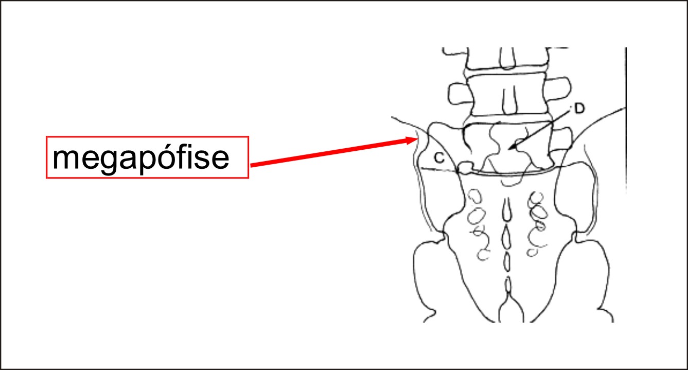 Sonho ser Mãe ♥: Megapófise Transversa doidoi