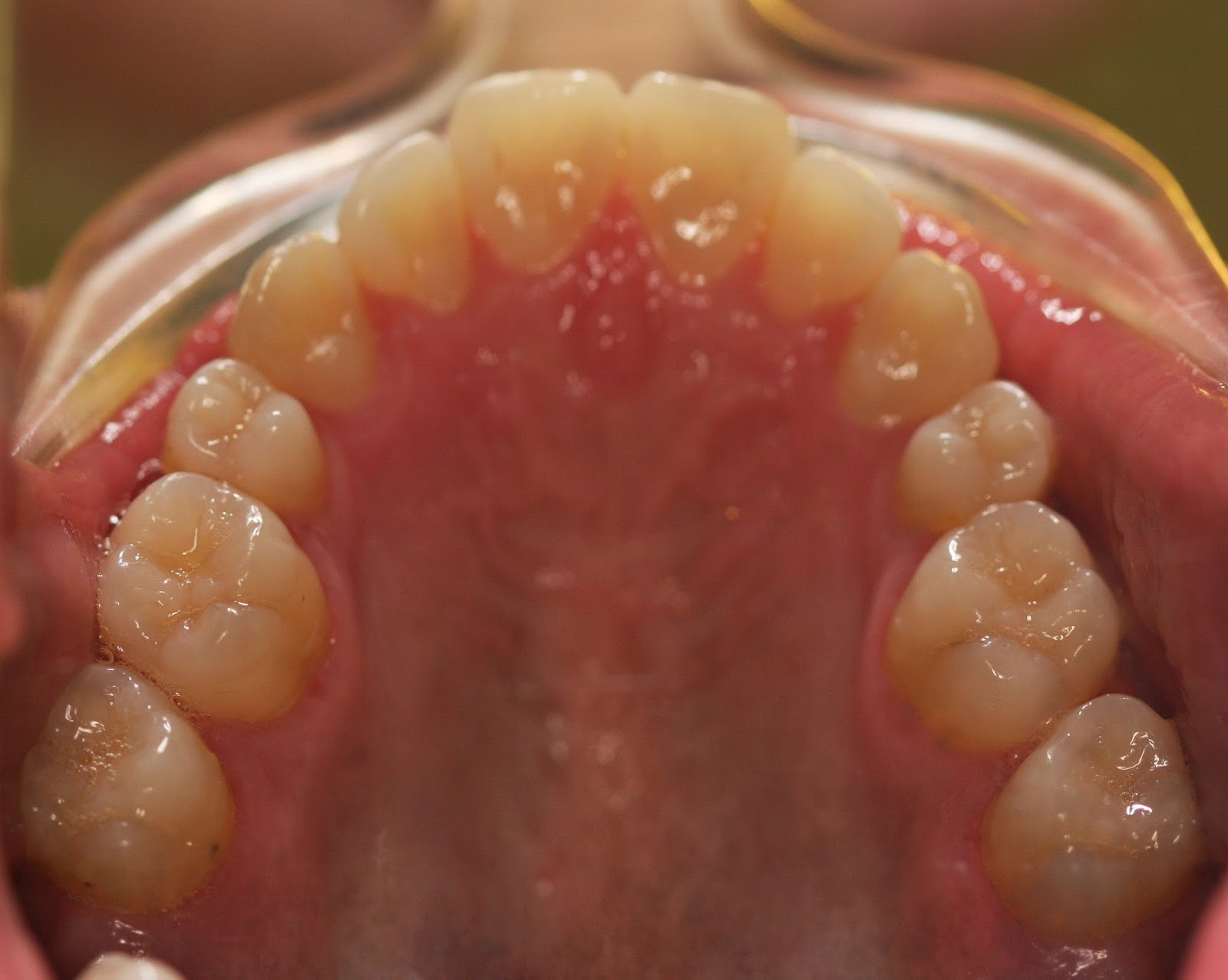 James R. Waters, DDS, MSD, PA: Crowded teeth can lead to early tooth loss.