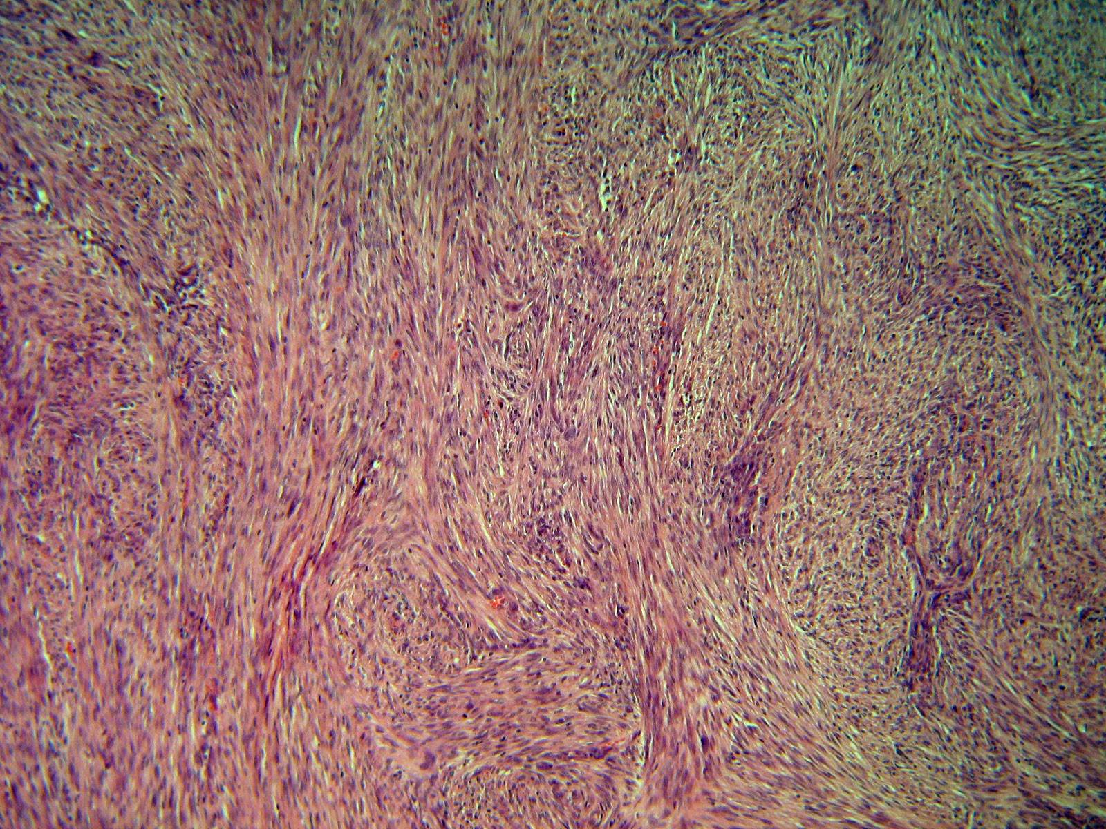 PATHfinder: Surgical Pathology Snapshot #2: an elderly man with a 3 cm ...