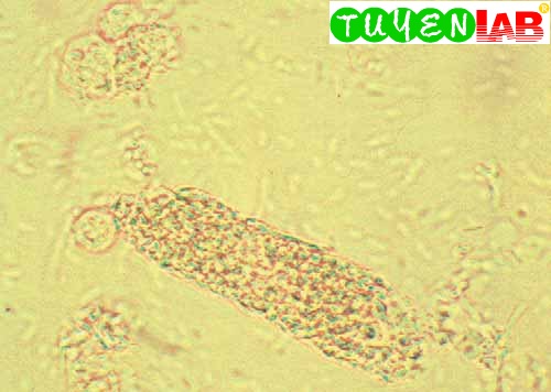 Atlas of Casts in urine | Free Medical Atlas