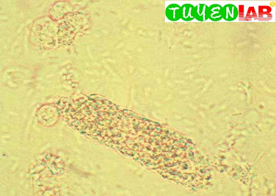 Atlas of Casts in urine | Free Medical Atlas