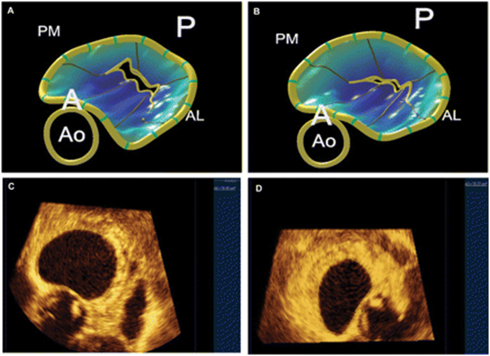 TENTANG JANTUNG: PENYAKIT KATUB JANTUNG